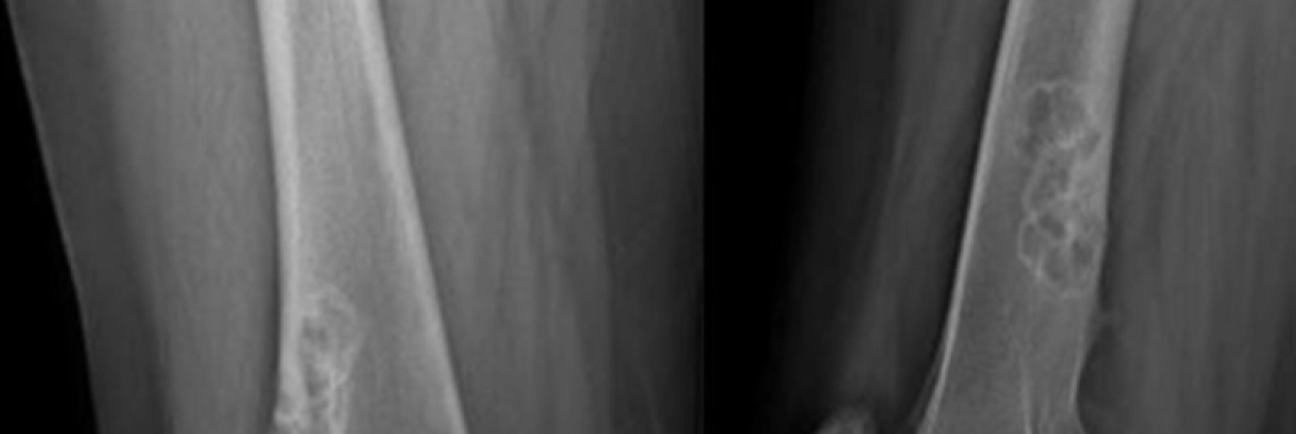 Non Ossifying Fibroma Drosman Civan