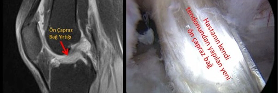 Ön Çapraz Bağ Yaralanmaları | Dr.Osman Civan